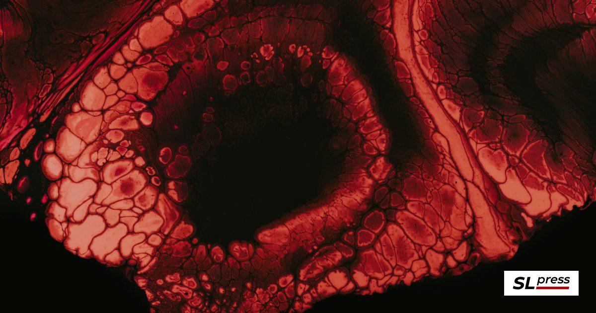 Τι είναι η υπερανδρογοναιμία στις γυναίκες - slpress.gr